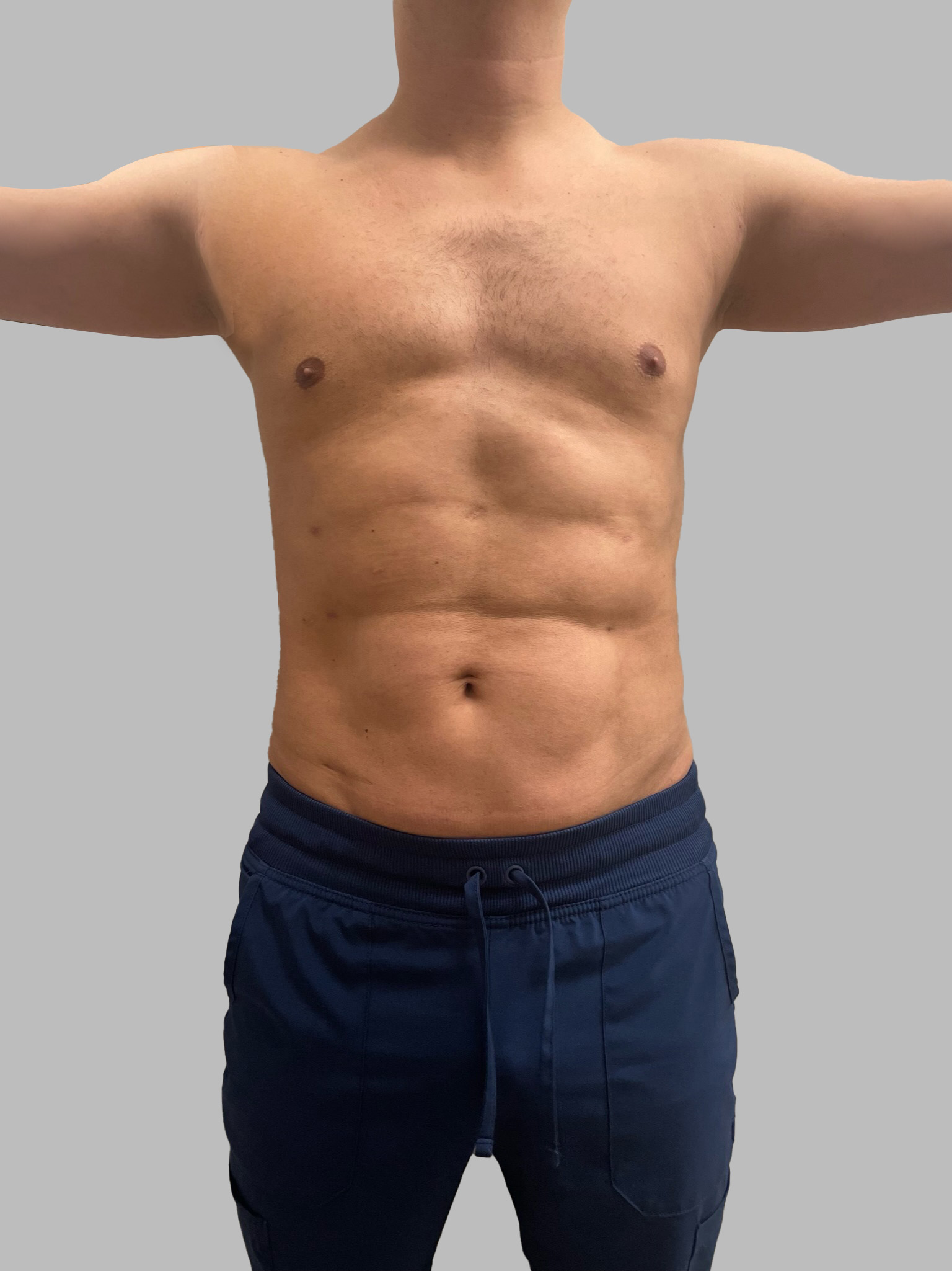 Male High Definition Liposuction Before and After - Fall River, MA - Dr ...